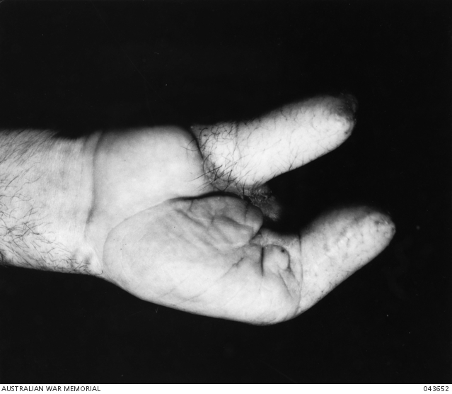 RECONSTRUCTIVE SURGERY FOR SEVEREST HAND MUTILATIONS. EXAMPLE SHOWN ...