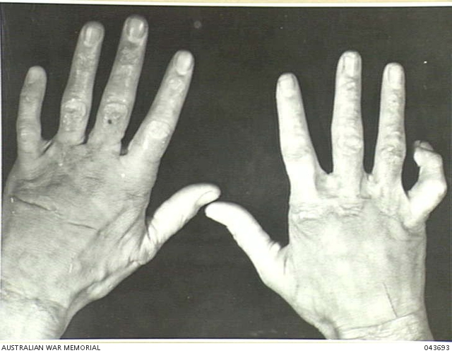 SERIES SHOWING TYPES OF SKIN GRAFT FOR BURNT HANDS. EXAMPLE SHOWS FINAL ...