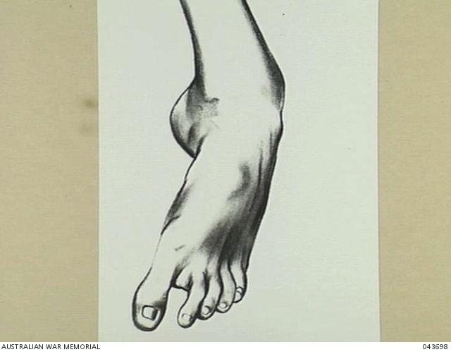 ILLUSTRATION OF FOOT DROP - NEURITIC BERIBERI. DRAWN BY A.G. OLD ...