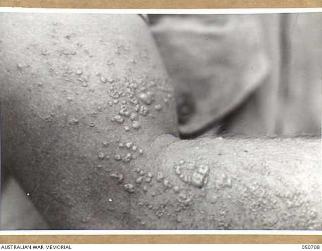 GRAFTON, NSW. 1943-04. BLISTERS SUSTAINED BY ARMY PERSONNEL TAKING PART ...