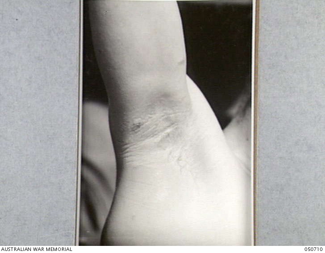 GRAFTON, NSW. 1943-04. BLISTERS SUSTAINED BY ARMY PERSONNEL TAKING PART ...