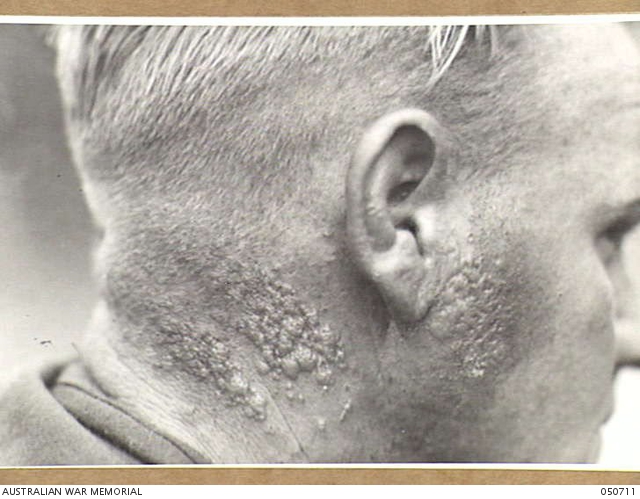 GRAFTON, NSW. 1943-04. BLISTERS SUSTAINED BY ARMY PERSONNEL TAKING PART ...
