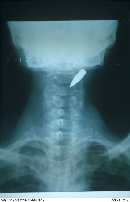 An x-ray showing a bullet in the neck of a patient in Le Loi hospital ...
