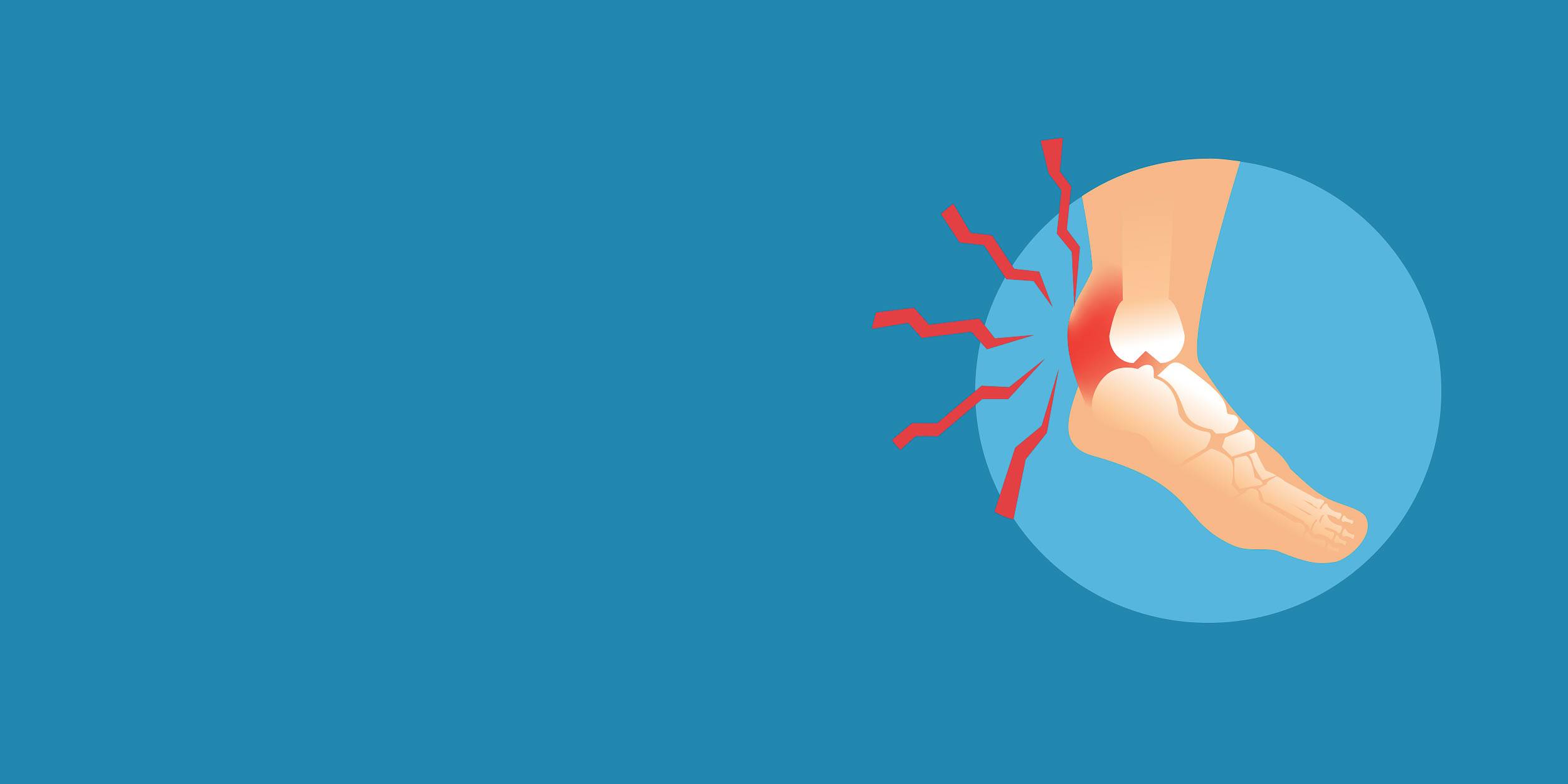 Clinical Edge - Free Achilles tendinopathy running rehab videos with ...