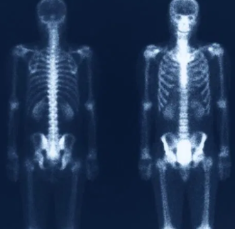Bone Scan