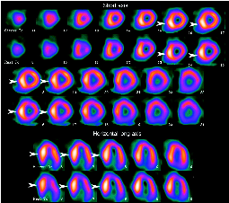 Myocardial Perfusion Scan