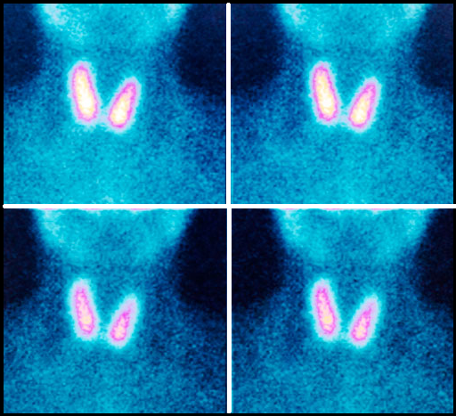Thyroid Scan