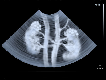 Renal Scan - DTPA/DMSA