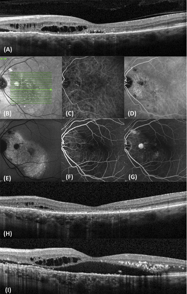 Central Serous Retinopathy Signs
