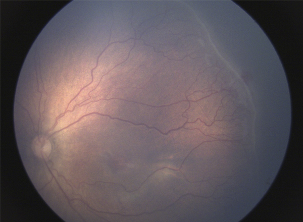 Retinopathy Of Prematurity Stage 3