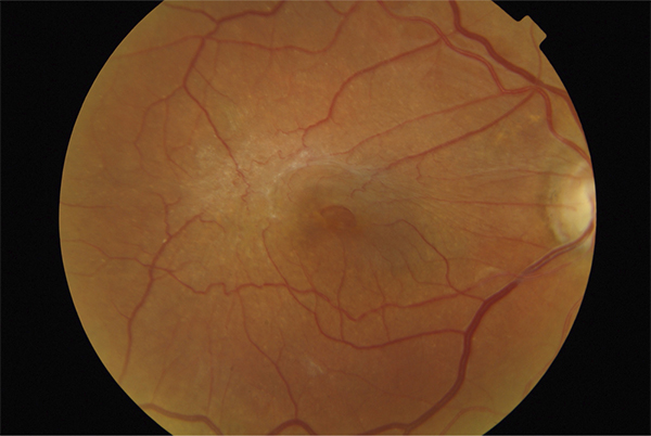 Erm Retina Epiretinal Membrane Surgery Outcome In Eyes With