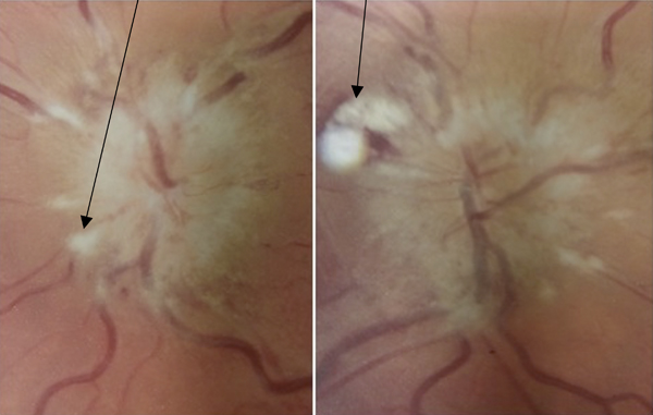 Normal Optic Nerve Vs Papilledema