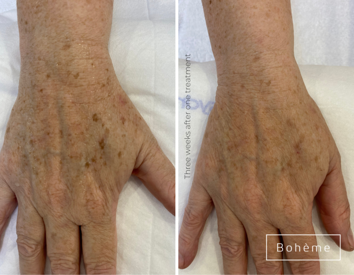 Top 5 Tips for Amazing Hands | Boheme Skin + Beauty