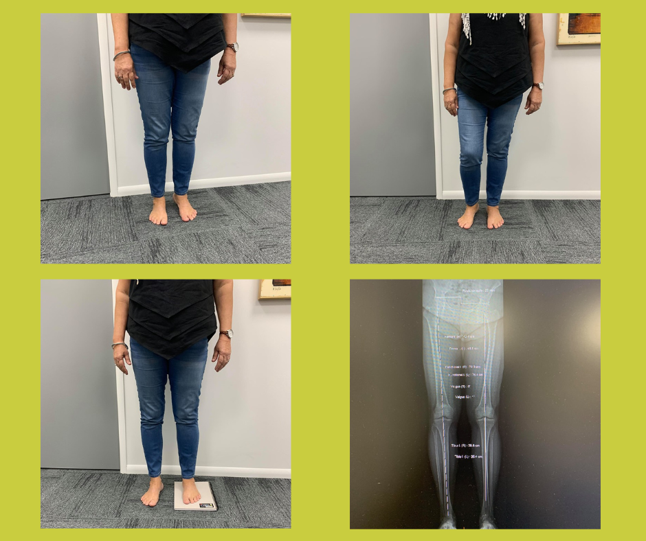 Leg Length Difference