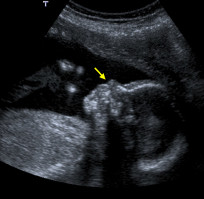 anencephaly scan